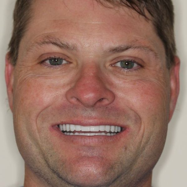 Smile Gallery | Columbia, SC Dentist Dr. Adam Hahn